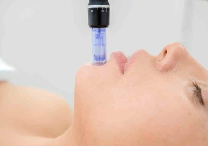 How to Prepare for Microneedling Treatment: A Step-by-Step Pre-Care ...